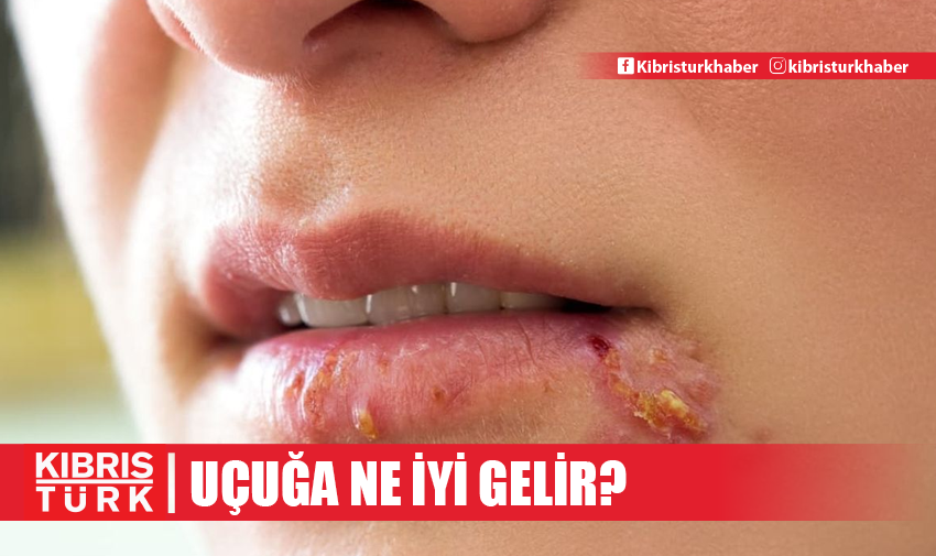 Uçuk neden çıkar, nasıl geçer? - Kıbrıs Türk Haber